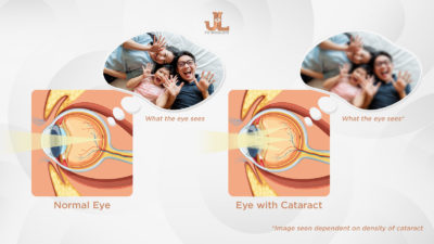 Cataract Specialists | Cataract Surgery Singapore | JL Eye Specialists
