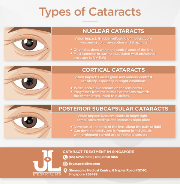 Different Types of Cataracts and Their Impact | J.L. Eye Specialist